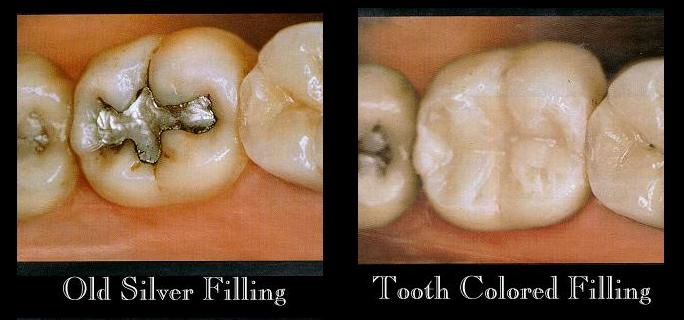 Evergreen Park Composite Fillings, Composite Fillings Evergreen Park